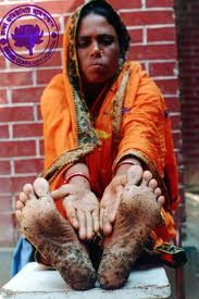 Arsenic: is it a "Real Killer"